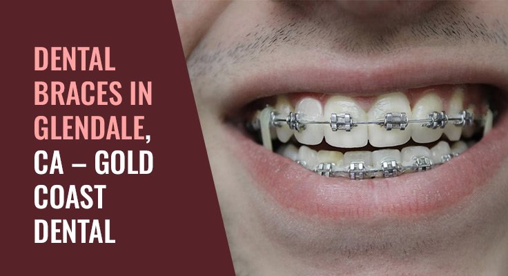 Dental Braces in Glendale for a Perfect Smile